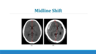 Head Trauma.pptx | First Aid | Injuries