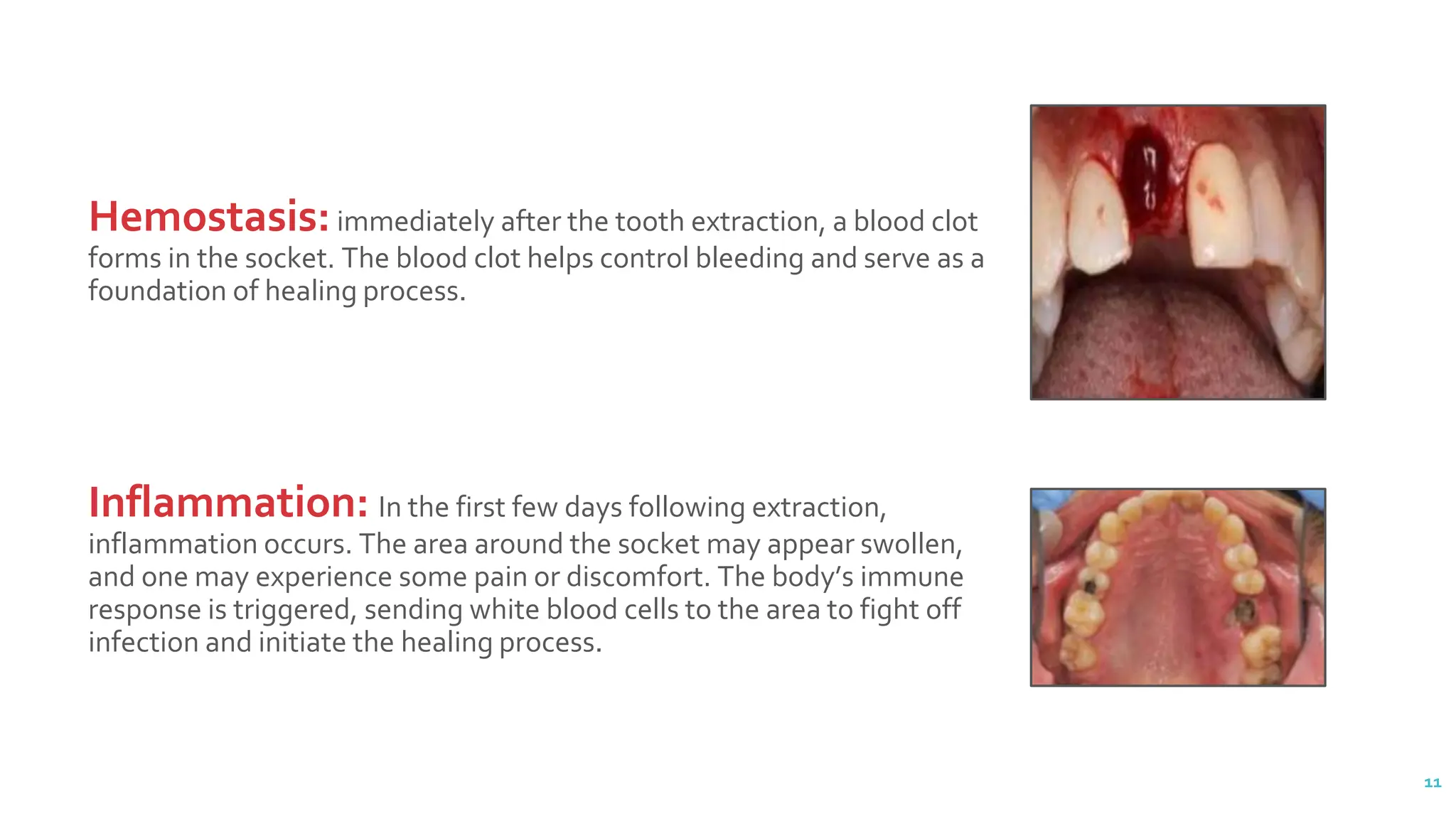 healing of extraction socket power point presentation | PPTX