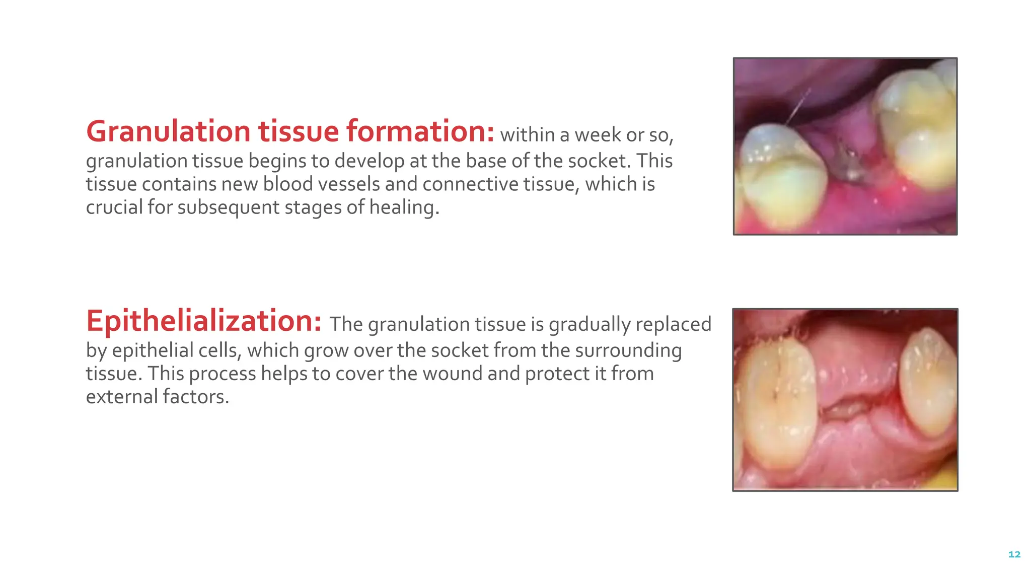 healing of extraction socket power point presentation | PPTX