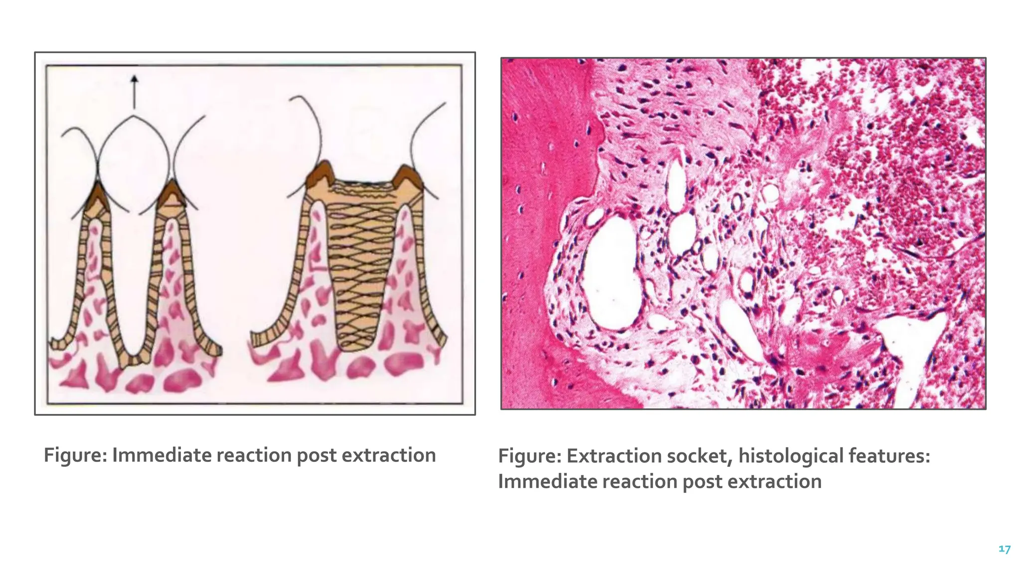 healing of extraction socket power point presentation | PPTX