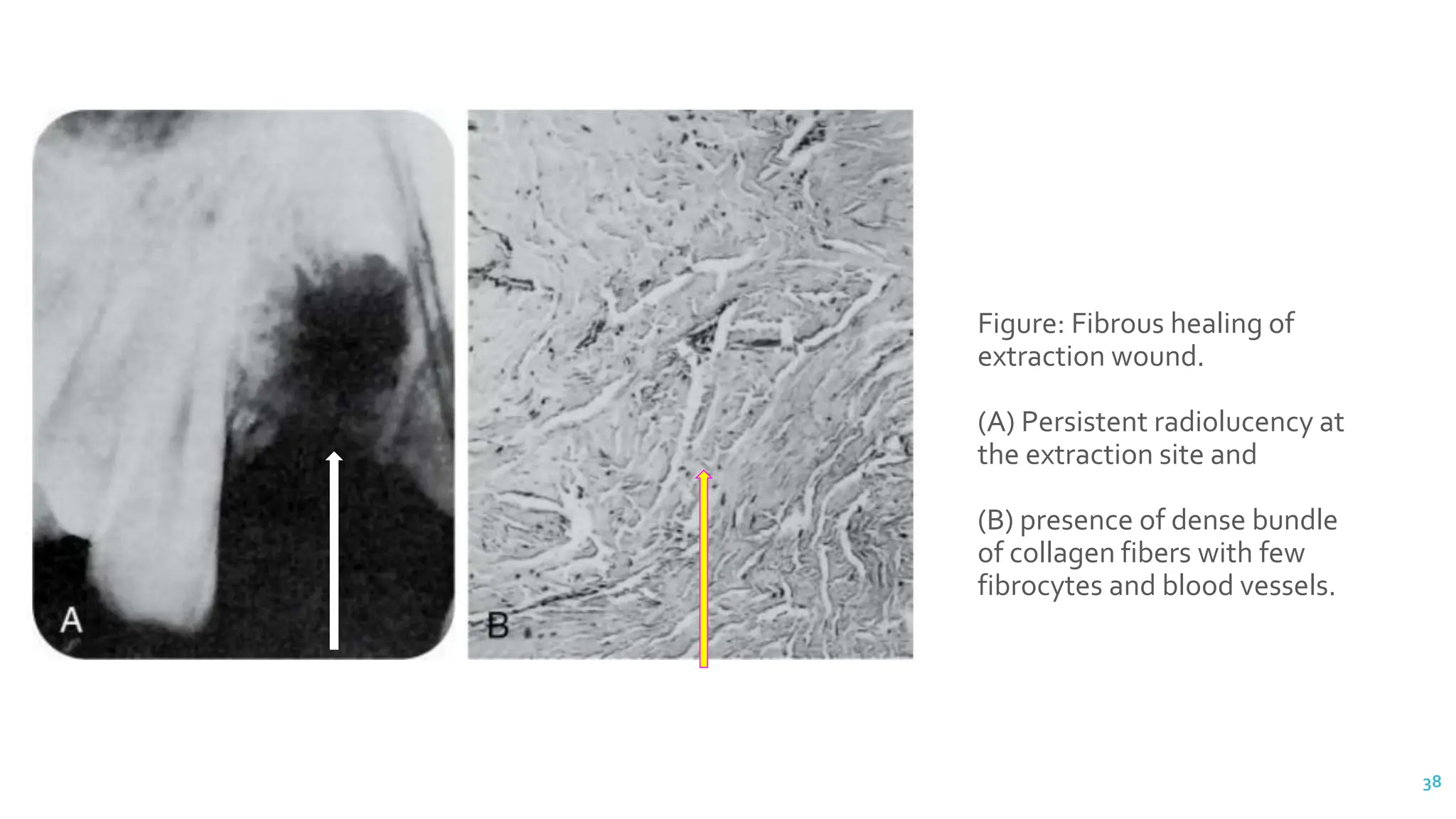 healing of extraction socket power point presentation | PPTX