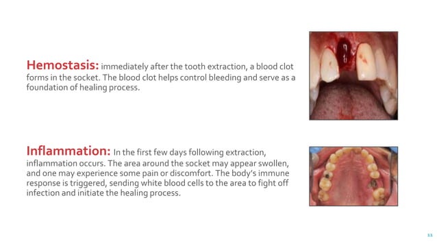 healing of extraction socket power point presentation | PPTX | Dental ...