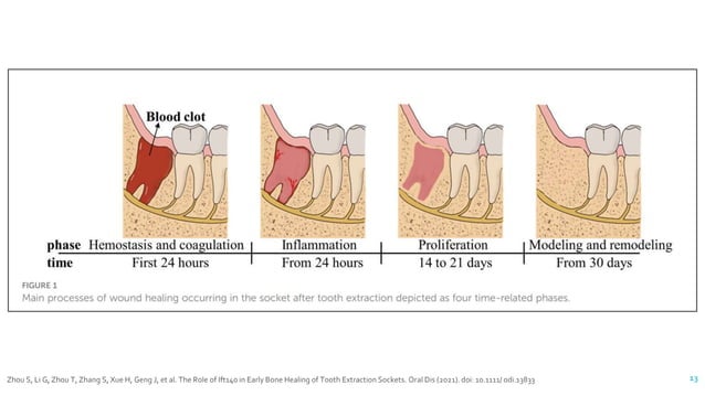 healing of extraction socket power point presentation | PPTX | Dental ...