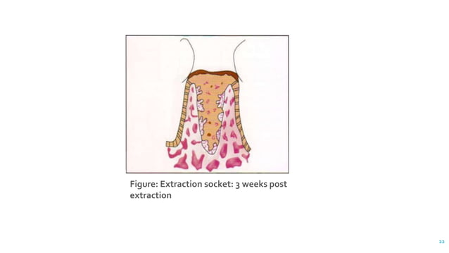 Healing Of Extraction Socket Power Point Presentation Pptx Dental Health Diseases And
