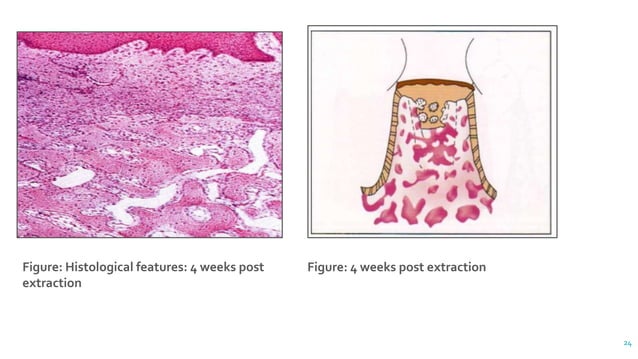 healing of extraction socket power point presentation | PPTX | Dental ...