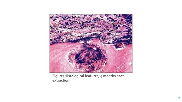 healing of extraction socket power point presentation | PPTX | Dental ...