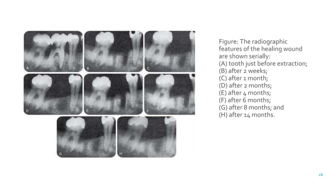 healing of extraction socket power point presentation | PPTX | Dental ...