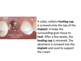 healing abutment .pptx