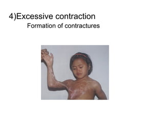 Healing and repair specialized tissue- 3 | PPT