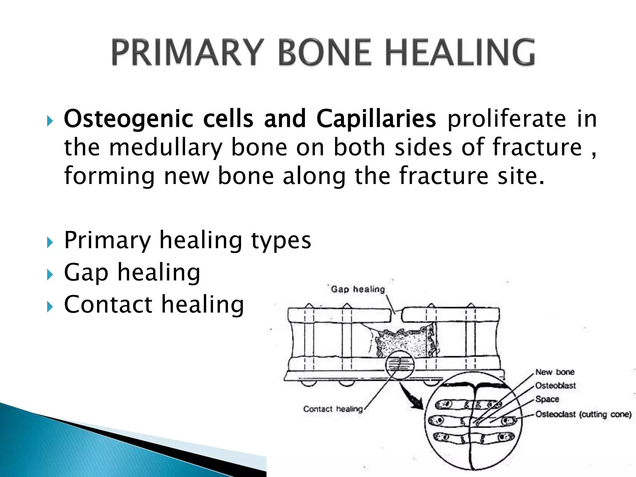 Fracture healing | PPTX