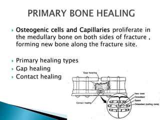 Fracture healing | PPTX