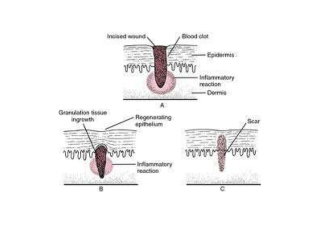 Healing of an open wound | PPTX