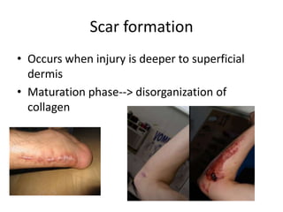 Healing of an open wound | PPTX