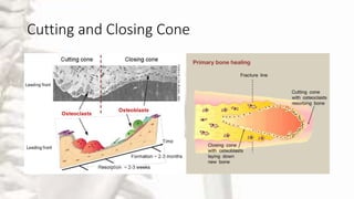 Healing of Bone - Dr. Shweta Yadav - Oral and Maxillofacial Surgery | PPTX