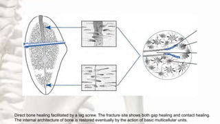 Healing of Bone - Dr. Shweta Yadav - Oral and Maxillofacial Surgery | PPTX