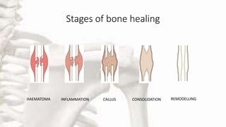 Healing of Bone - Dr. Shweta Yadav - Oral and Maxillofacial Surgery | PPTX