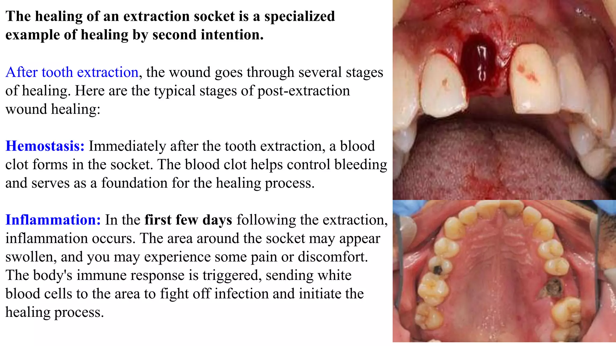 Healing Of Extraction Wound.pdf