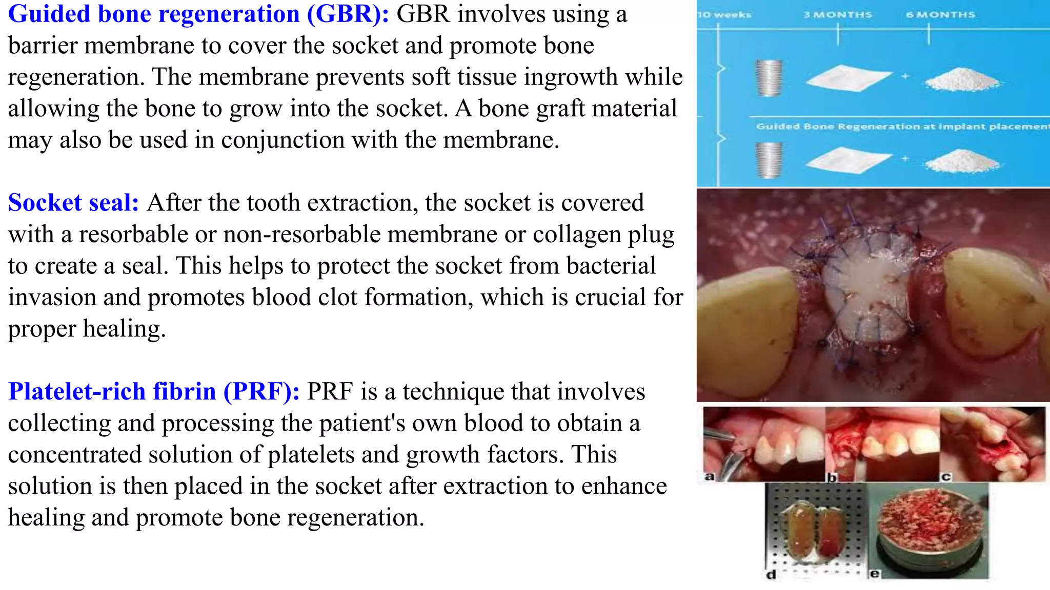 Healing Of Extraction Wound.pdf