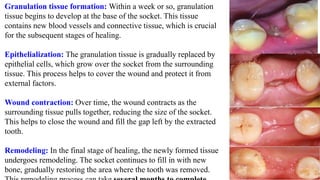 Healing Of Extraction Wound.pdf