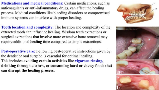 Healing Of Extraction Wound.pdf | Dental Health | Diseases and Conditions