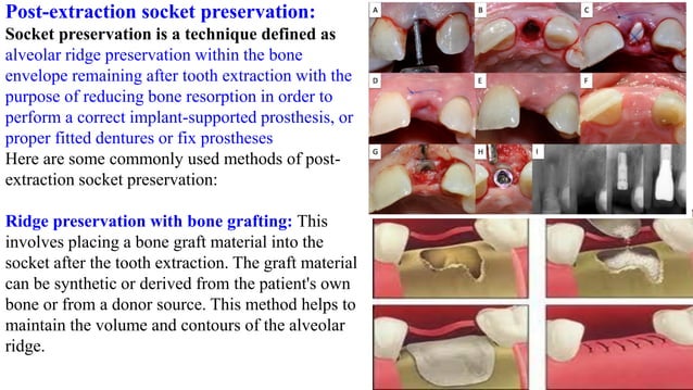 Healing Of Extraction Wound.pdf | Dental Health | Diseases and Conditions