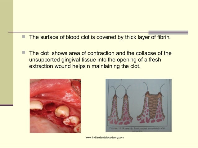 BONE CHANGES AFTER TOOTH EXTRACTION /orthodontic courses by Indian de…