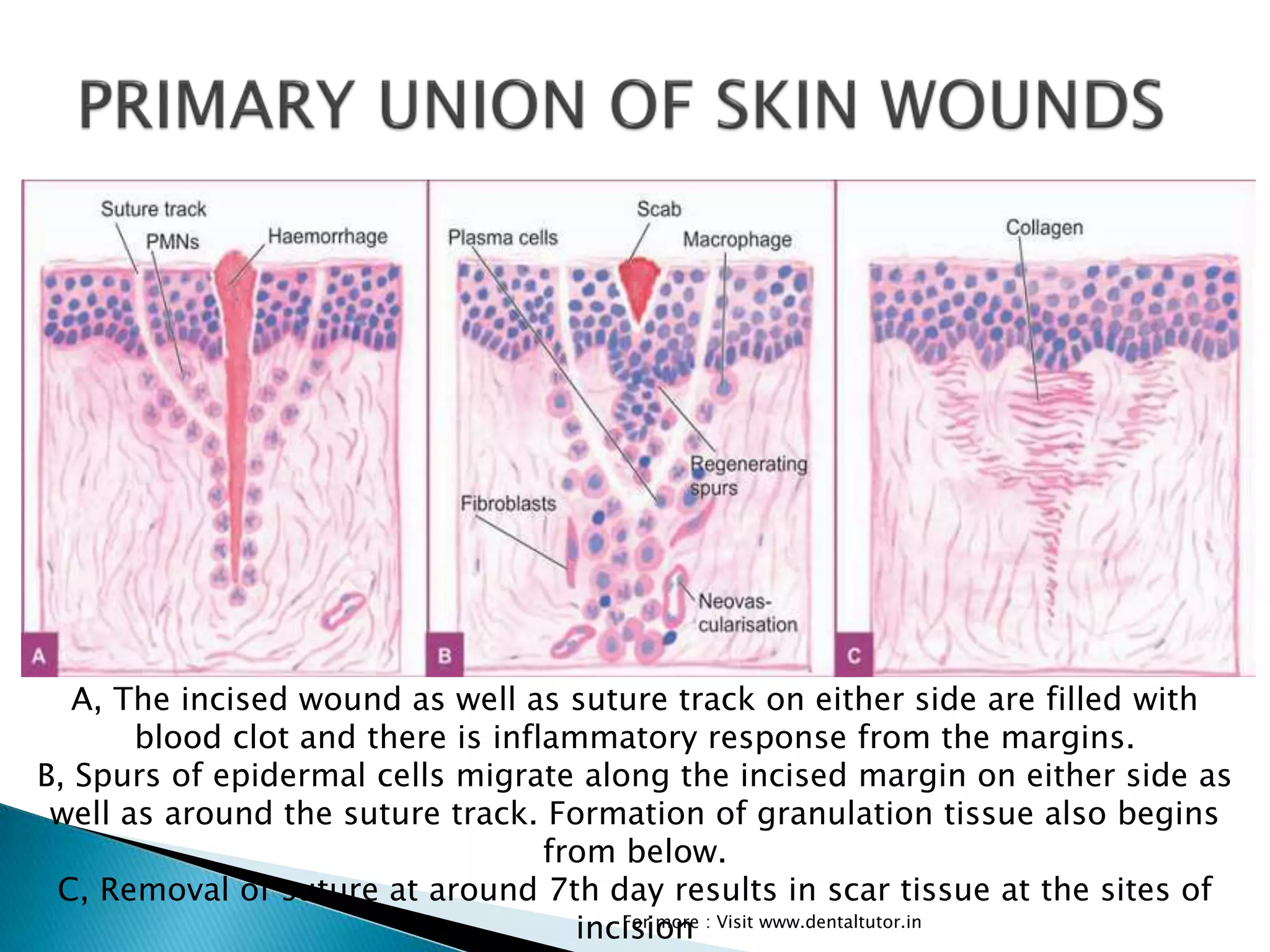 Healing of wound | PPTX