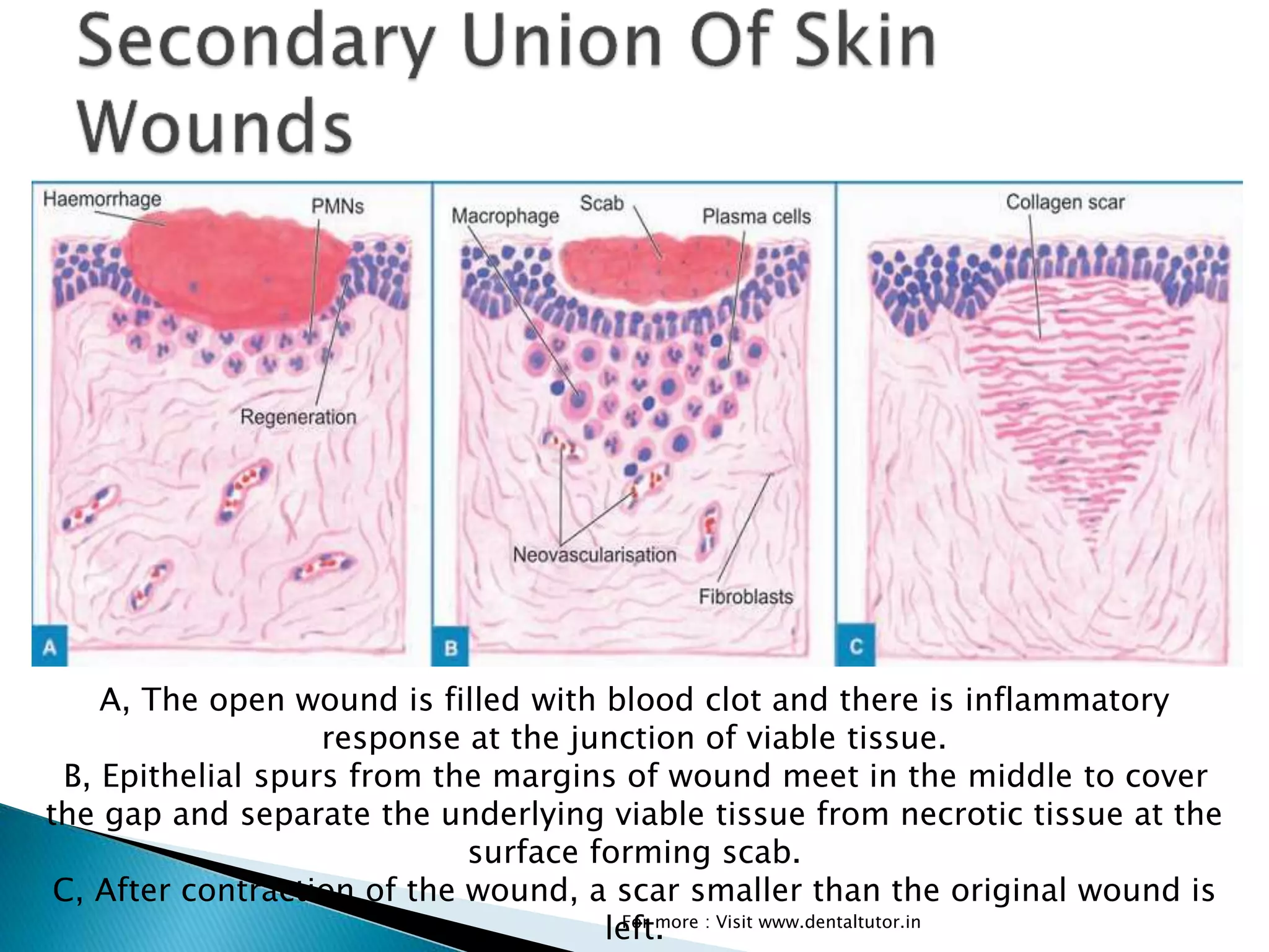 Healing of wound | PPTX