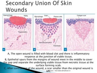 Healing of wound | PPTX