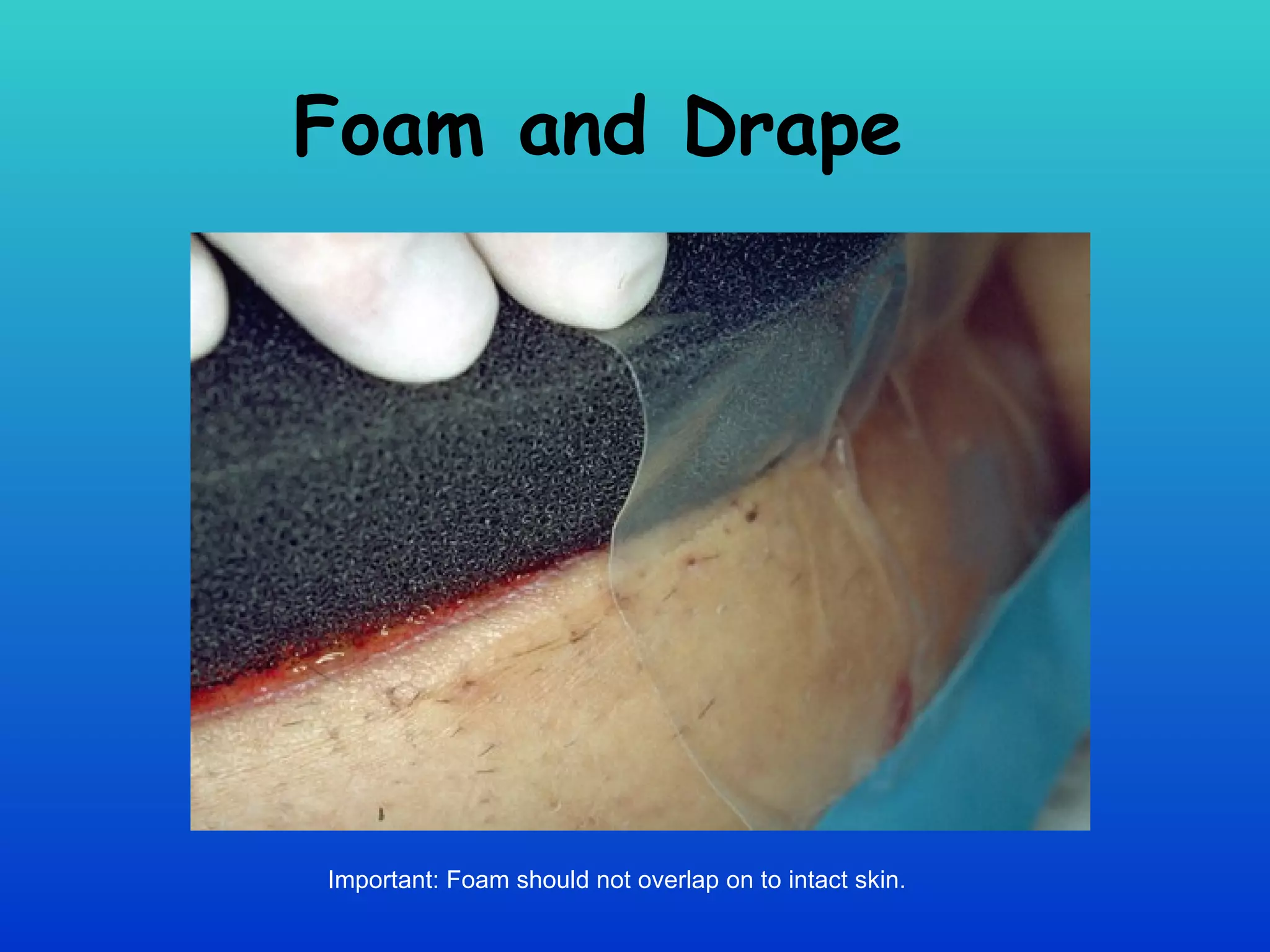 Healing The Wound The Vac System In Woundcare | PPT