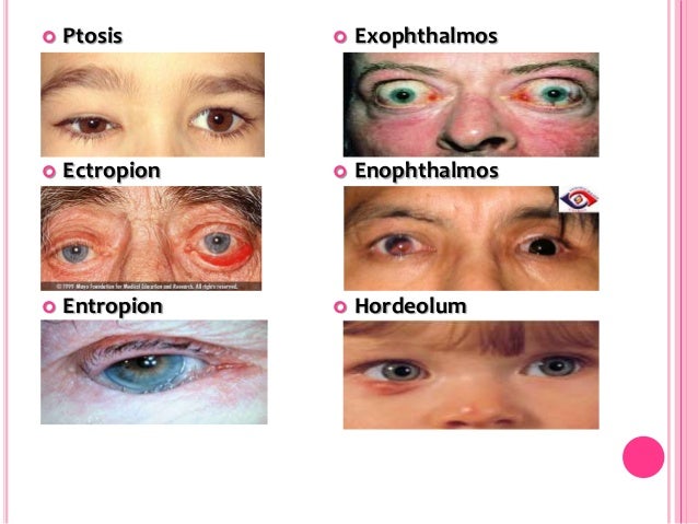 Healt assessment - Eyes