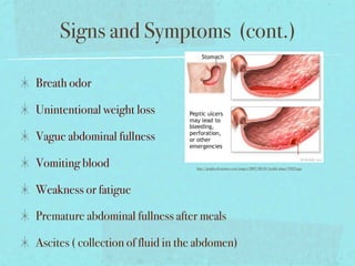Health 10 Ppt[1]. Stomach Cancer | KEY