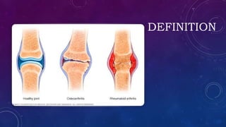 Arthritis | PPTX