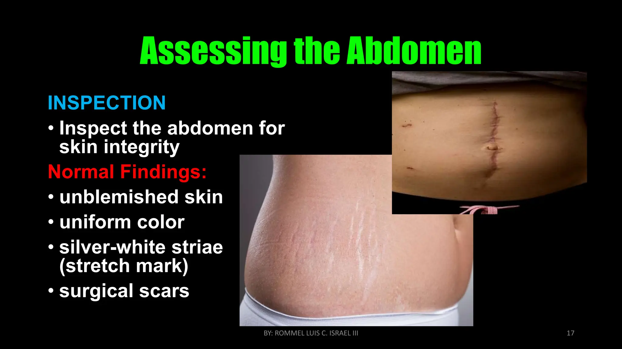 HEALTH ASSESSMENT IN NURSING - ABDOMEN (2) | PPTX