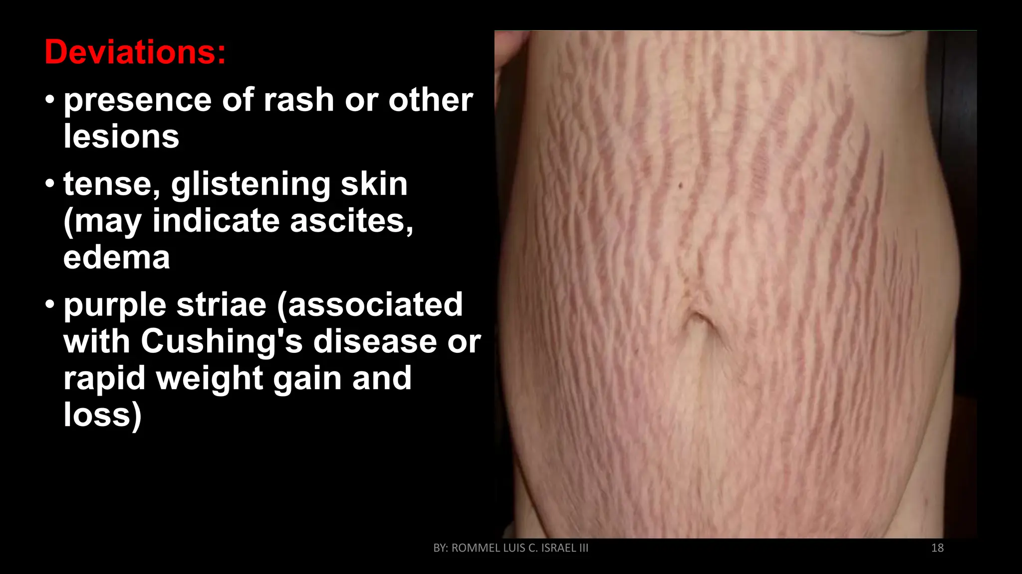 HEALTH ASSESSMENT IN NURSING - ABDOMEN (2) | PPTX