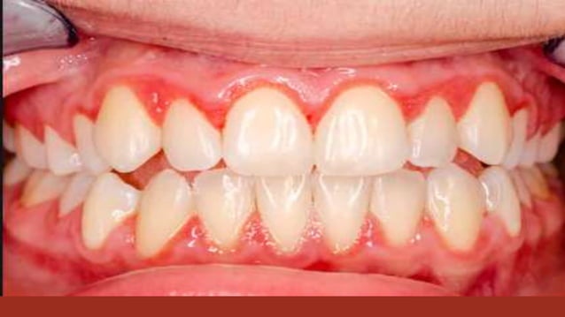 Health assessment on the mouth and oropharynx examination | PPTX ...