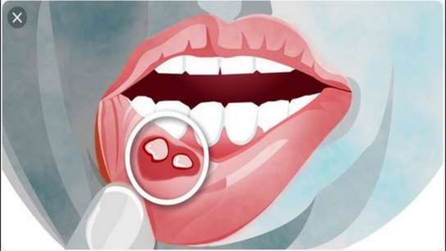 Health assessment on the mouth and oropharynx examination | PPTX ...