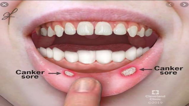 Health assessment on the mouth and oropharynx examination | PPTX ...
