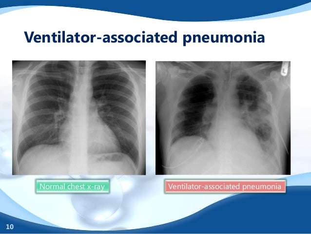 Healthcare associated infections and eskape pathogens