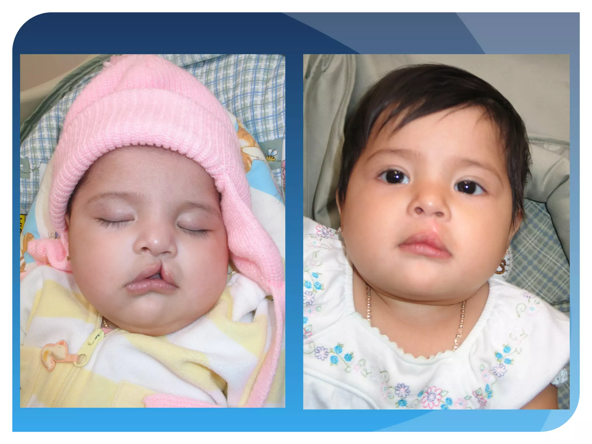 Pediatric Plastic Surgery | PPT