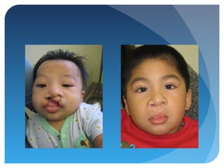 Pediatric Plastic Surgery | PPT