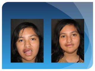 Pediatric Plastic Surgery | PPT