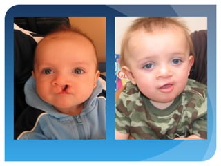 Pediatric Plastic Surgery | PPT