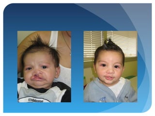 Pediatric Plastic Surgery | PPT