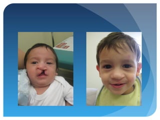 Pediatric Plastic Surgery | PPT