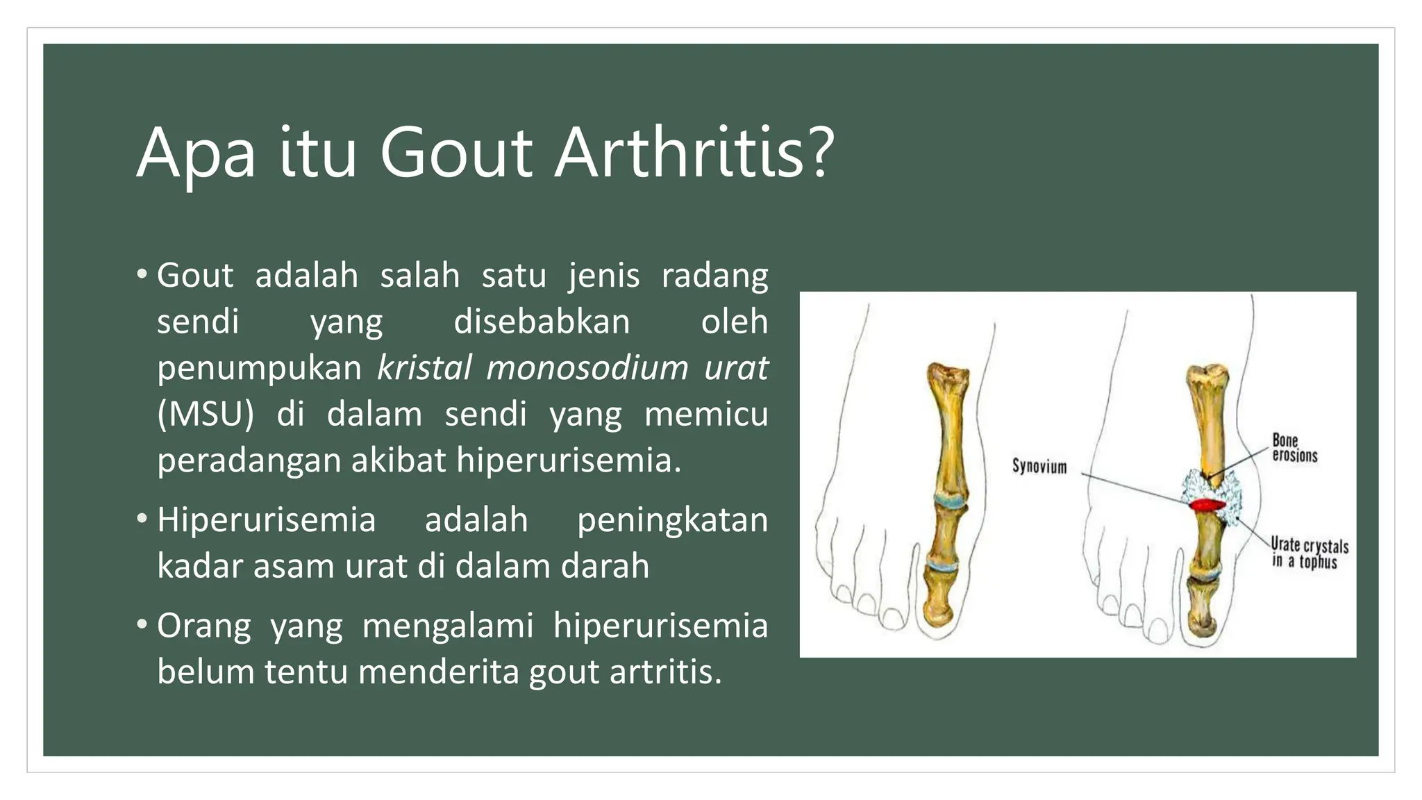 Health Talk - ASAM URAT DAN GOUT ARTHRITIS.pptx