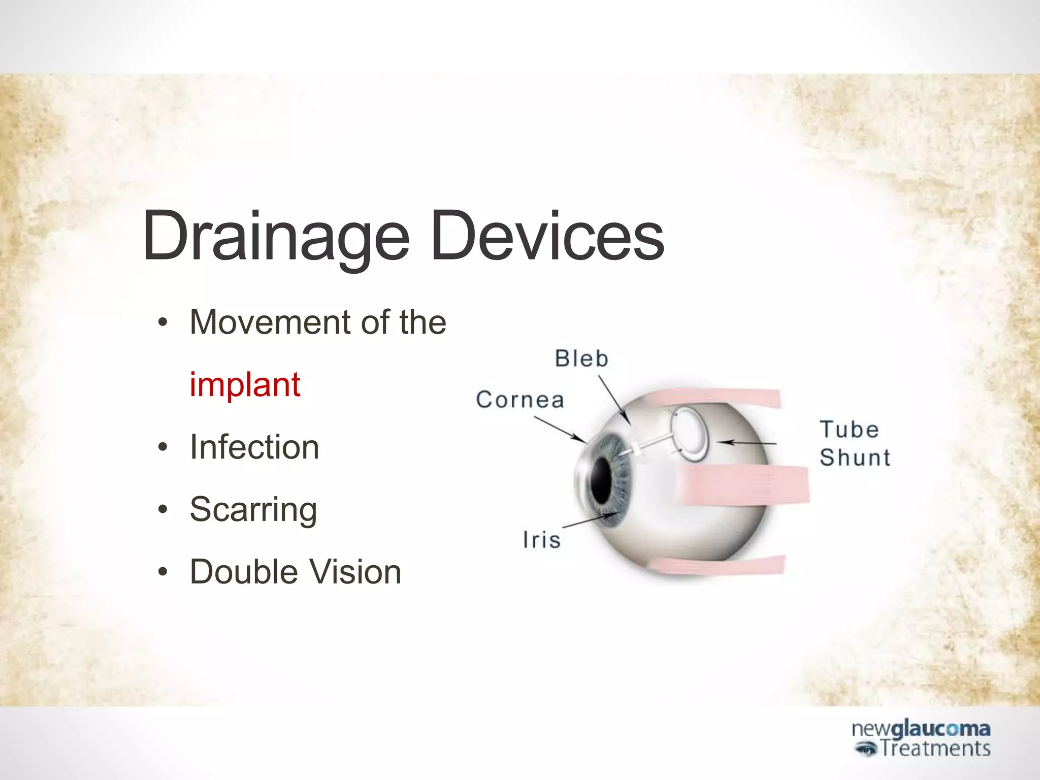 Canaloplasty New Glaucoma Treatment – HealthTalk at San Gabriel Valley ...