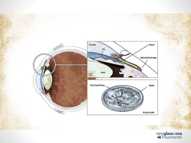 Canaloplasty New Glaucoma Treatment – HealthTalk at San Gabriel Valley ...