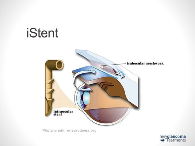 Canaloplasty New Glaucoma Treatment – HealthTalk at San Gabriel Valley ...