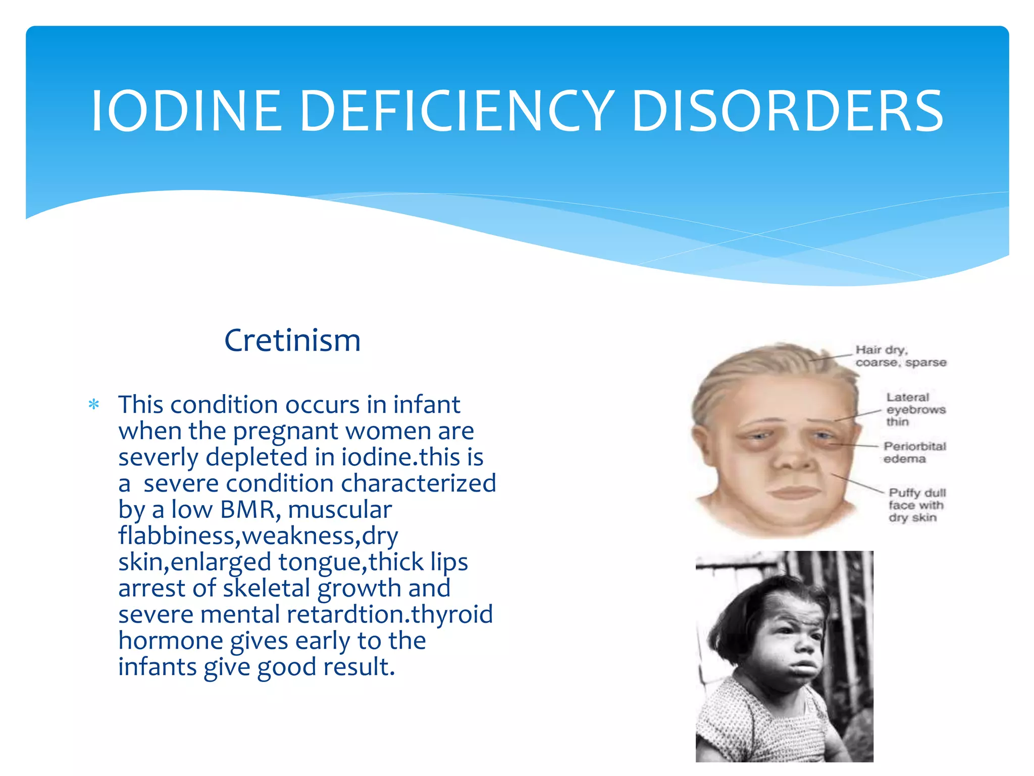 Health talk on iodine deficiency | PPTX